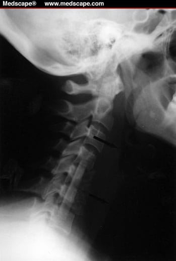 Anteromedial Approach for Cervical Disc Surgery - Page 3