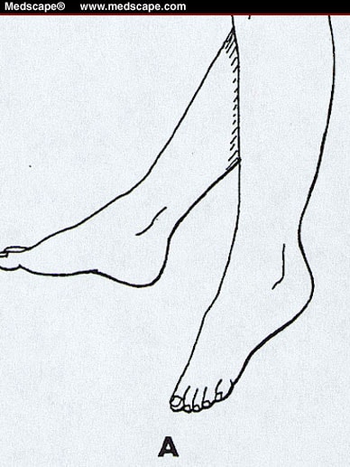 The Expert Opinion - Complete Ruptures of the Achilles Tendon - Page 7