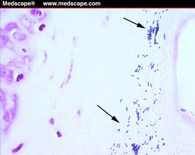 A Perinatal Pathology View of Preterm Labor - Page 8