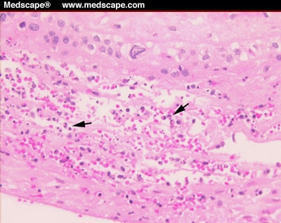 A Perinatal Pathology View of Preterm Labor - Page 8