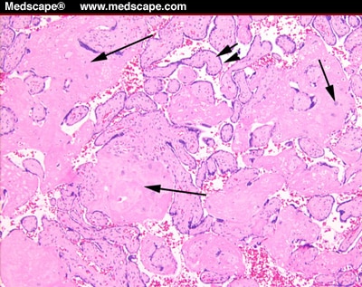 A Perinatal Pathology View of Preterm Labor - Page 8