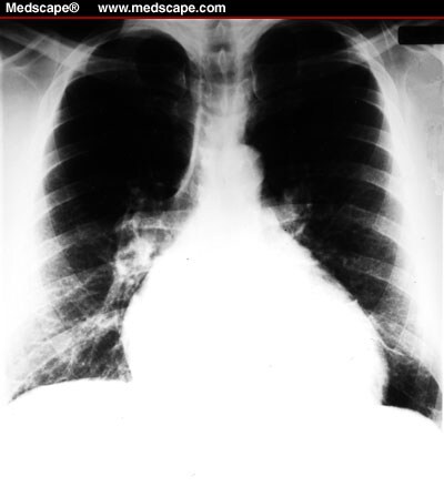 Full Recovery From Severe Dilated Cardiomyopathy