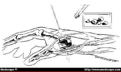 Trapezial Resection Arthroplasty for Osteoarthritis - Page 3