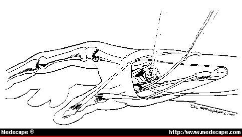 Trapezial Resection Arthroplasty for Osteoarthritis - Page 3