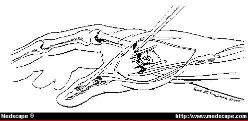 Trapezial Resection Arthroplasty for Osteoarthritis - Page 3