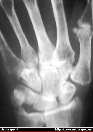 Trapezial Resection Arthroplasty for Osteoarthritis - Page 5