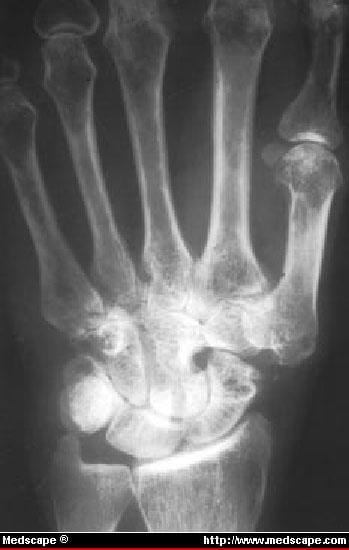 Trapezial Resection Arthroplasty for Osteoarthritis - Page 5
