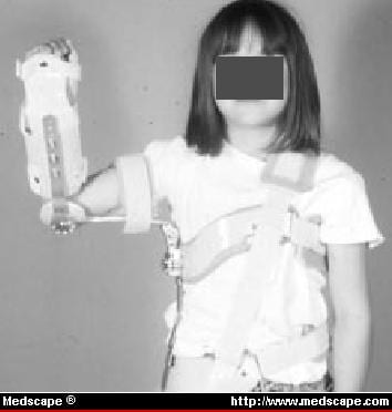 Sever-L'Episcopo Tendon Transfer - Page 2