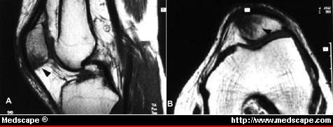 Subchondral Contusion of the Knee - Page 3