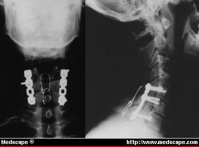 Fixation of the Cervical Spine - Page 2