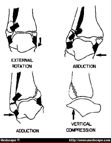 Fractures of the Ankle: Pathogenesis and Treatment - Page 4