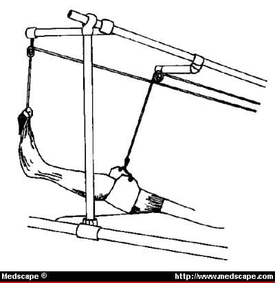 Fractures of the Ankle: Pathogenesis and Treatment - Page 4