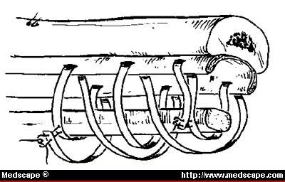 Digital Flexor Sheath: Repair and Reconstruction - Page 5