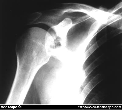 Intraosseous Ganglia of Glenoid - Page 2