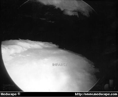 Hip Arthroscopy in Staging Avascular Necrosis of the Femoral Head - Page 3