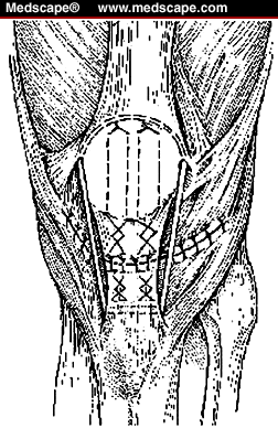 Primary Patellar Tendon Repair and Early Mobilization - Page 2