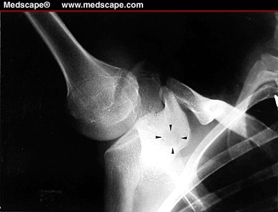 Osteoid Osteoma of the Coracoid Process - Page 2