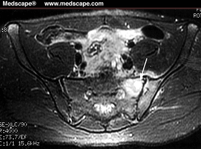 Septic Sacroiliitis: The Overlooked Diagnosis - Page 2