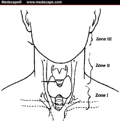 Neck Zones Trauma Head Ppt Powerpoint Presentation Sketch Coloring Page
