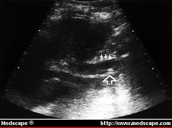 Normal Common Bile Duct Ultrasound