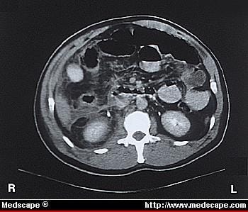 Abdominal CT Scan