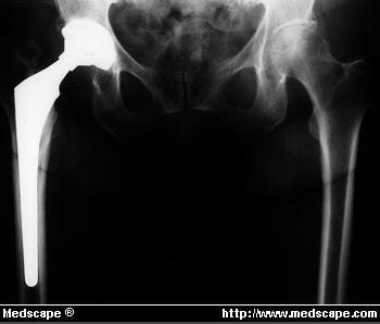 Right Total Hip Arthroplasty