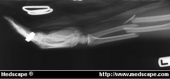 Radiograph of 26-Year-Old Woman with Left Forearm Injury