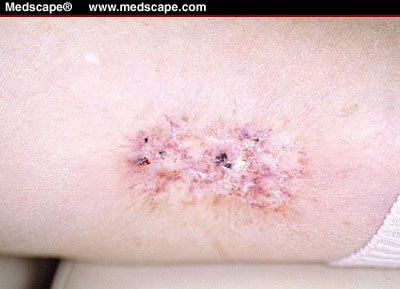 Atrophic Telangiectatic Plaque on the Leg