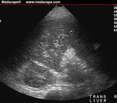 Acute Hepatitis in a 44-Year-Old Woman