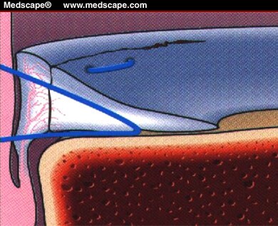 Meniscal Repair 2000 - Page 4