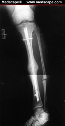 Management of Leg Length Inequality - Page 5