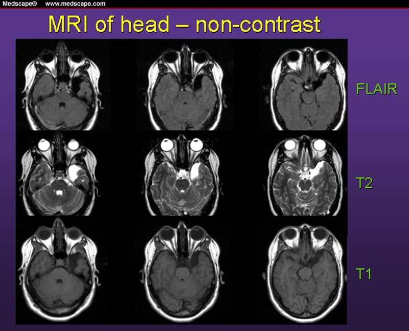 A 44-Year-Old Man With Abnormal MRI