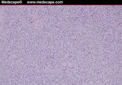 A Slowly Enlarging, Tender Plaque