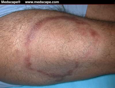 Annular Plaque on the Right Thigh