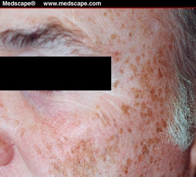 Extensive Macular Pigmentation on the Face