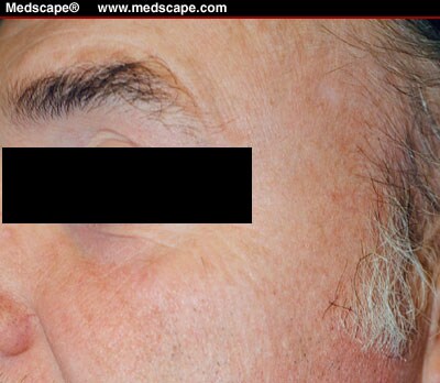 Extensive Macular Pigmentation on the Face - Page 2