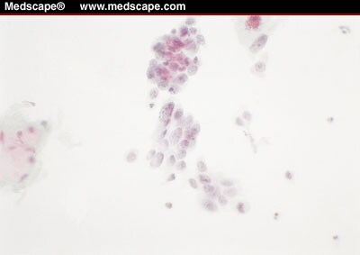 The Unsatisfactory ThinPrep Pap Test