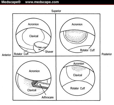 Variation of the Arthroscopic Mumford Procedure - Page 3