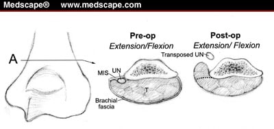 Snapping of the Medial Head of the Triceps - Page 3
