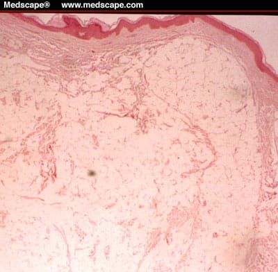 Mass of Flesh-Colored Papules