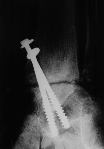 Tibiotalar Salvage Procedures for Failed Ankle Arthrodesis - Page 4