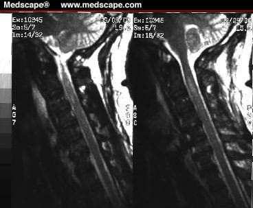 Case 12: A 56-Year-Old Man With Acute Quadriparesis - Page 5