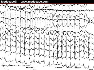 Wide-Complex Tachycardia in a Patient Presenting with Chest Pain