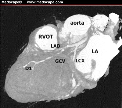 Three-Dimensional Coronary Anatomy - Page 2