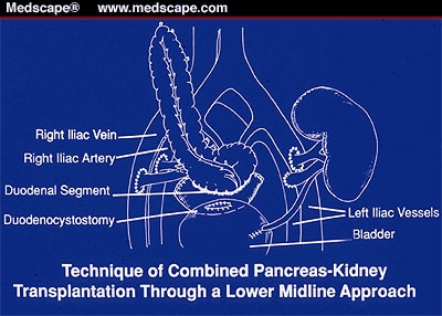 Pancreas Transplantation - Page 9
