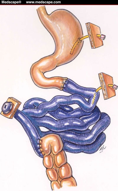 Intestine Transplantation - Page 9