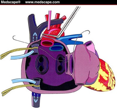 Heart Transplant Diagram