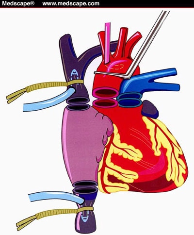 Heart Transplantation - Page 6