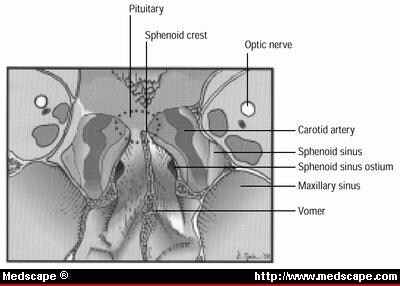 Paraseptal Sphenoidotomy Approach for Pituitary Tumors