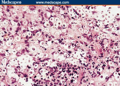 Worsening Rash in a Patient With Autoimmune Hepatitis
